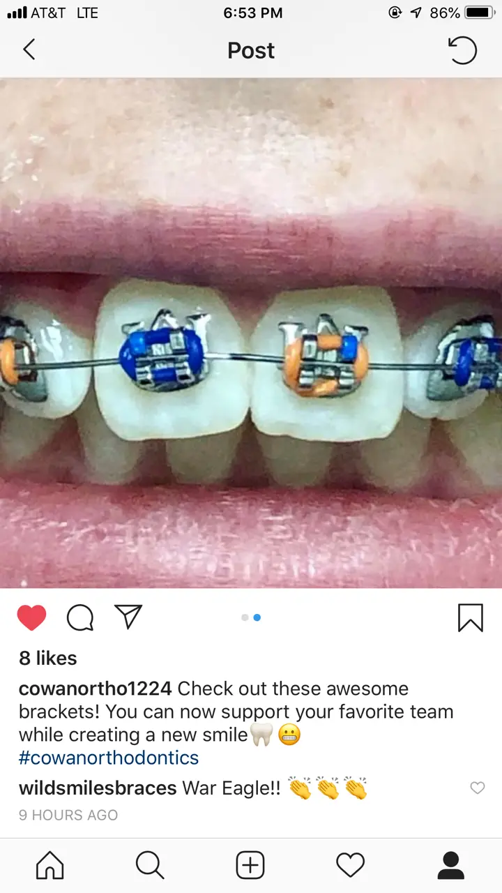 WildSmiles Braces | Embrace Your Expression